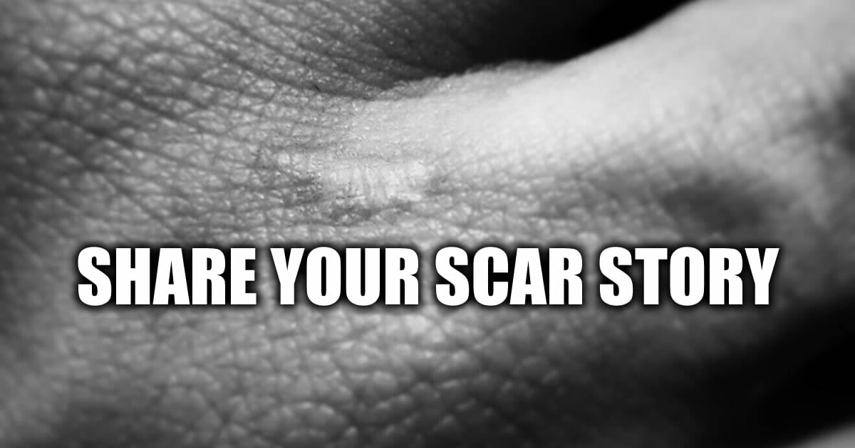 What's your scar story? - 9GAG