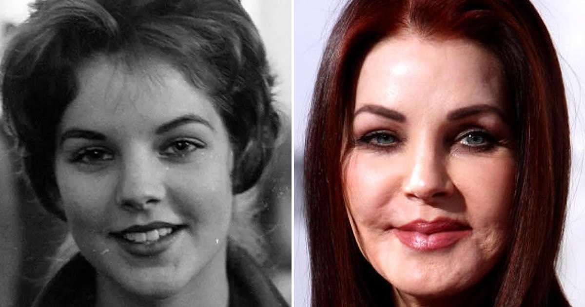 Startling Before-And-After Photos Of Cosmetic Surgery - 9GAG