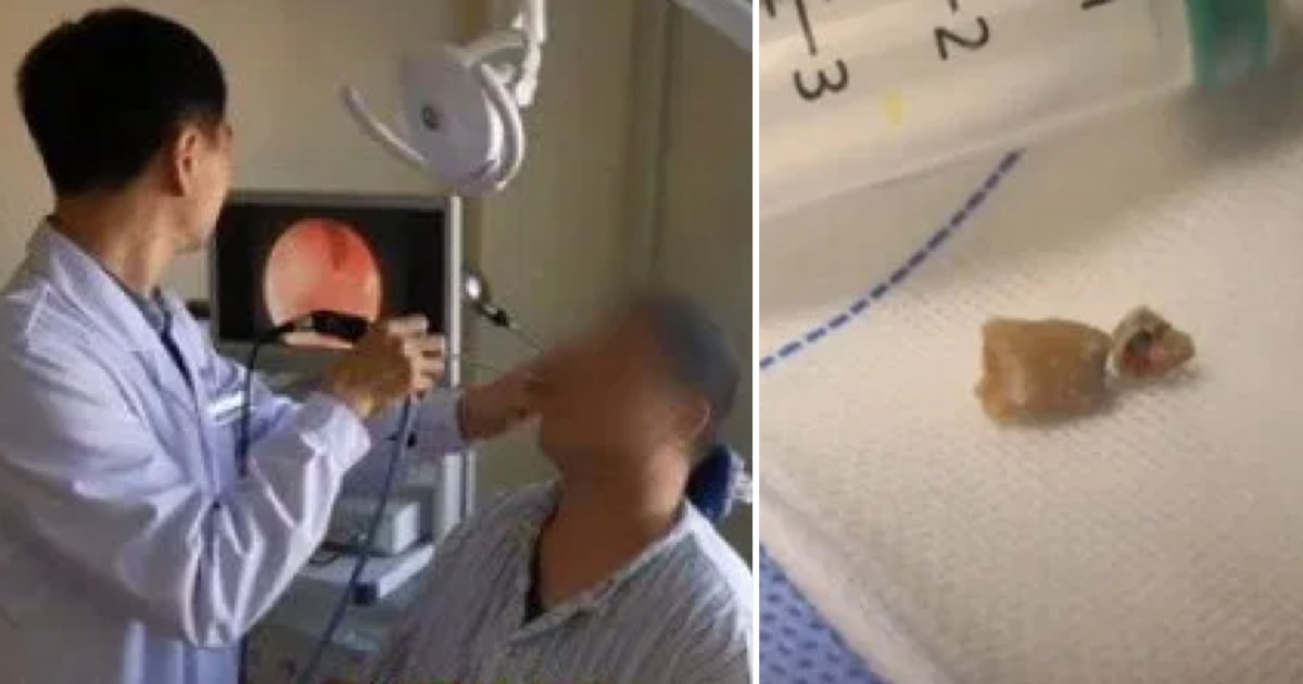 Man’s Blocked Nose Was Caused By Tooth Growing In His Nostril - 9GAG