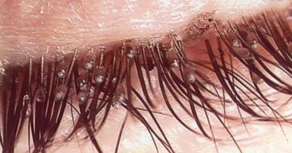 Doctor Warns About The Surge In Cases Of Lice Lash On Eyelash ...