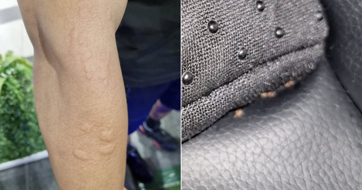 Man's Arm Ravaged By Bed Bugs Hidden in Shopping Mall Massage Chair - 9GAG