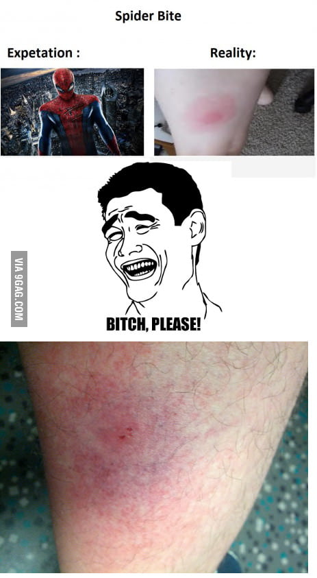 Call that a spider bite? - 9GAG