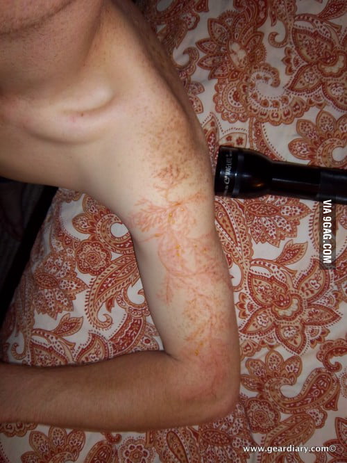 This guy got a scar after a lightning strike near him! - 9GAG
