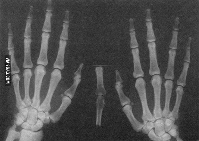 X-ray of a bone-r - 9GAG