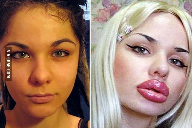 She applyed silicone for a permanent DUCKFACE - 9GAG