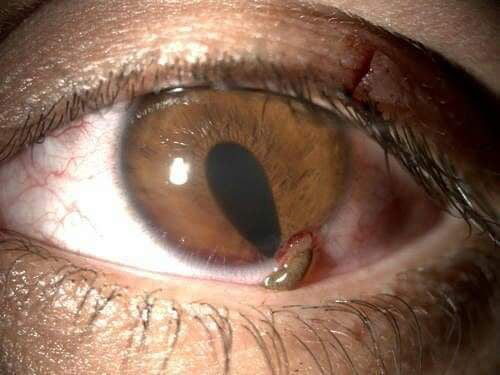Prolapsed iris: Your iris could basically leak out of a hole in your ...