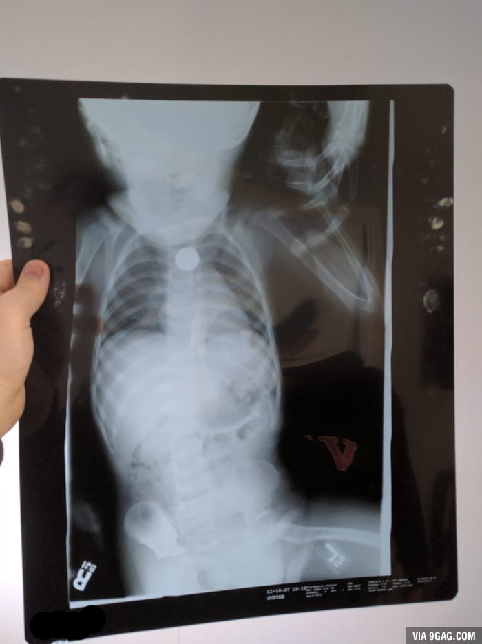 "X-Ray from when I got a penny stuck in my esophagus when I was 2, and my mom was holding my ...