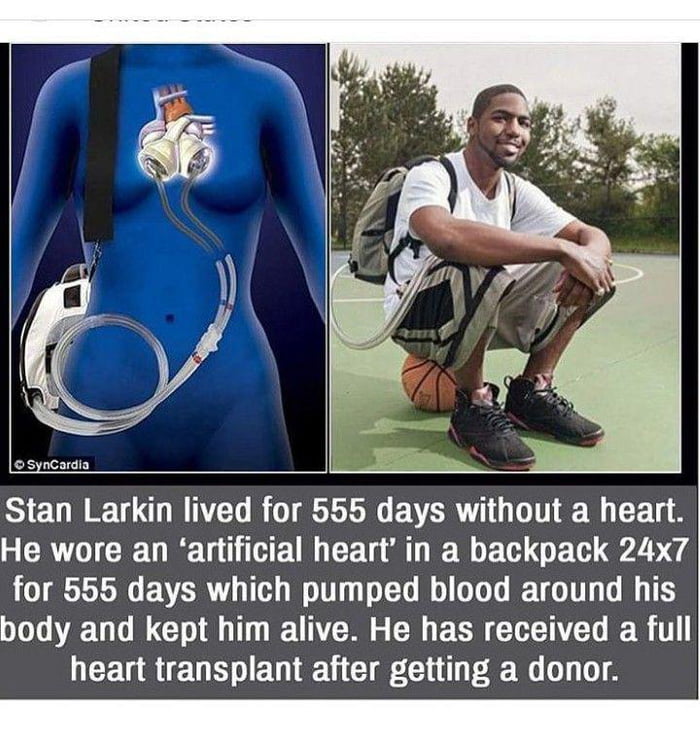 Heartless but not defeated: Man lives without a heart for 555 days - 9GAG