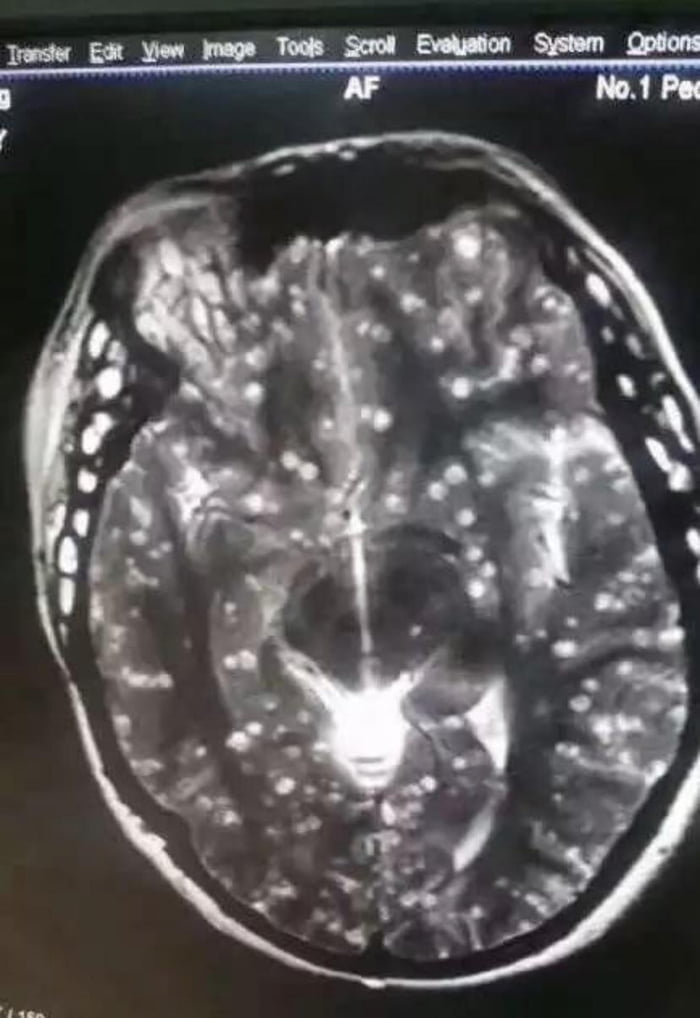 Body riddled with parasites as a result of eating raw pork for 10 years ...