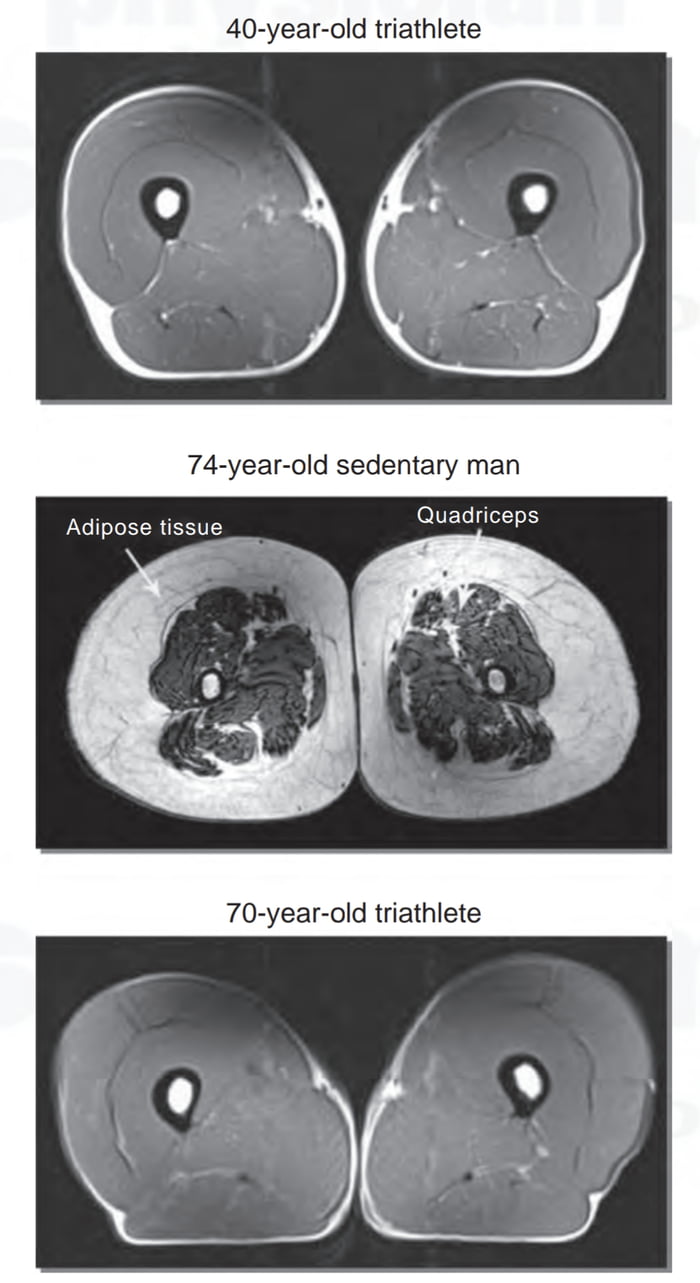 MRI cross sections of upper legs, showing the difference in muscle ...