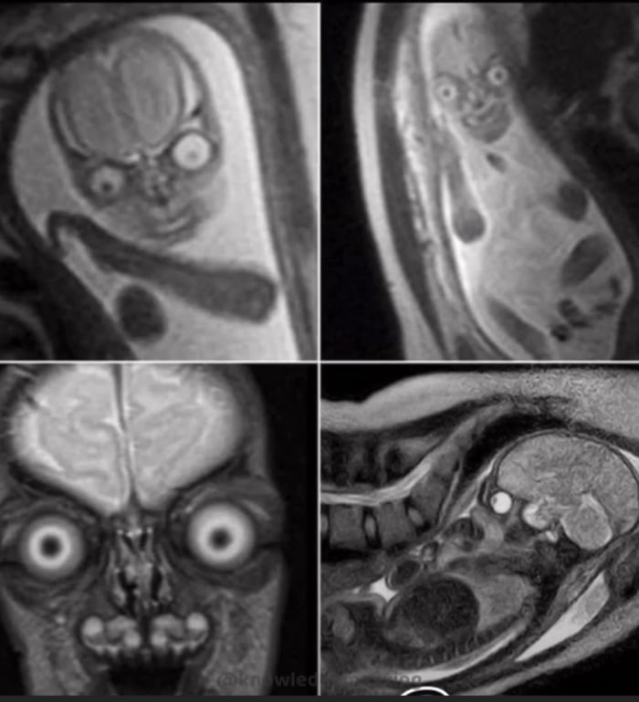 MRI scan of a baby - 9GAG