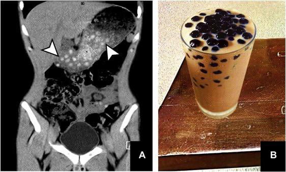 Here’s what bubble tea (boba) looks like in your belly on a CT scan. I ...