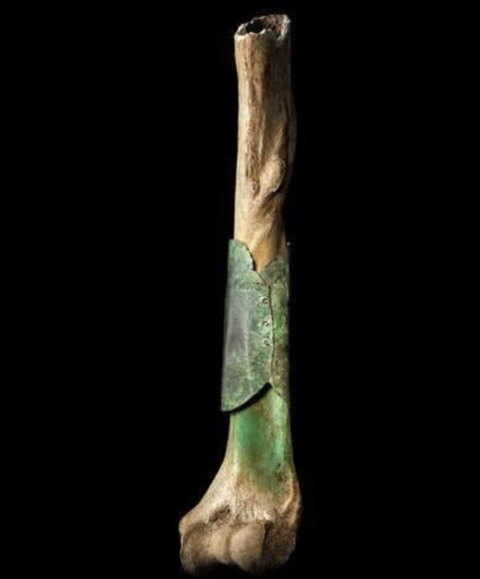A medieval surgeon repaired this broken bone with riveted copper. New ...