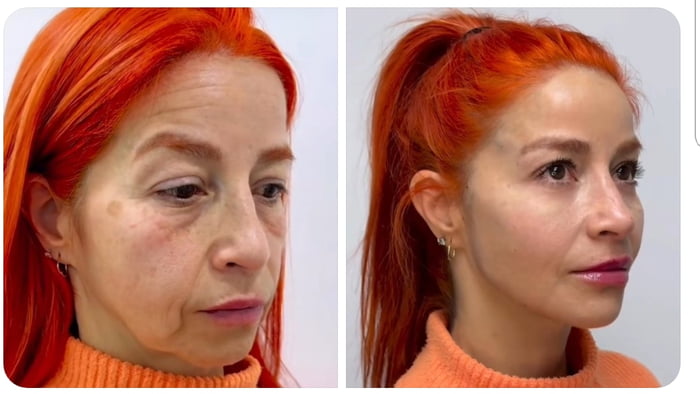 Now this is one of the best plastic surgery examples I've ever seen - 9GAG