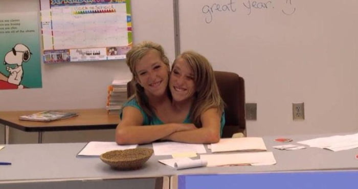 Conjoined twins born with a 1/30 million chance of survival are now ...