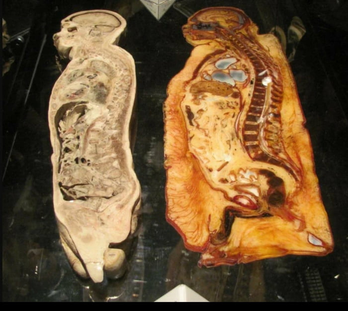 A cross section of an obese male next to a fit male. - 9GAG