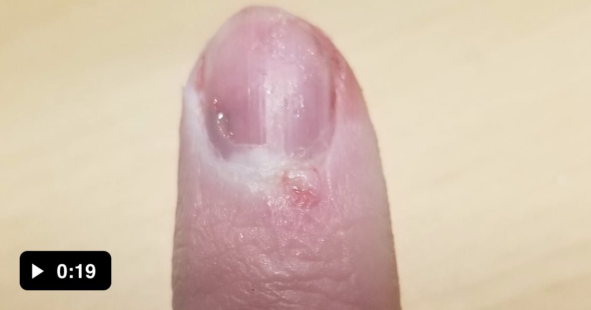 Time-lapse of finger nail recovery - 9GAG