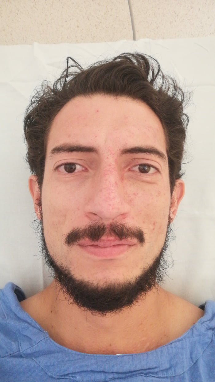 Am about to get my right testicle removed. I sat too quick and kinda ...