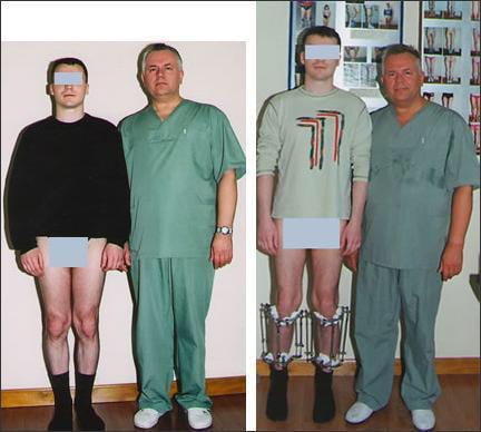 Height lengthening surgery, going from 5’7 to 6 feet after a very ...