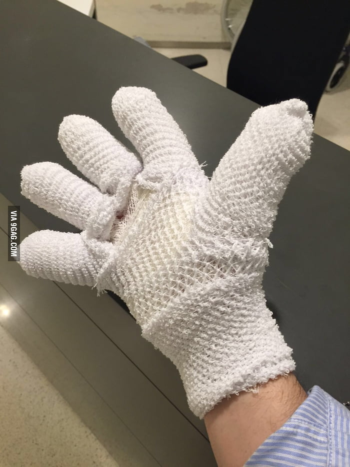 My uncle burned his hand the other day. It looks like Mickey Mouse's ...