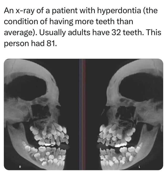 An x-ray showing the effects of hyperdontia, where one person had 81 ...
