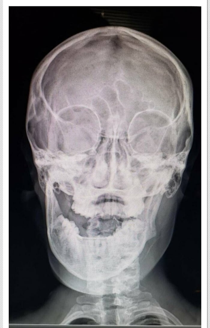 This person dislocated their jaw while eating cereal - 9GAG