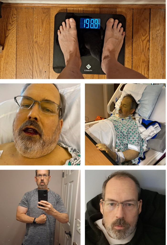 What a difference a year makes. Hospital photos of me from Oct 2020. Now under 200 lbs for the ...