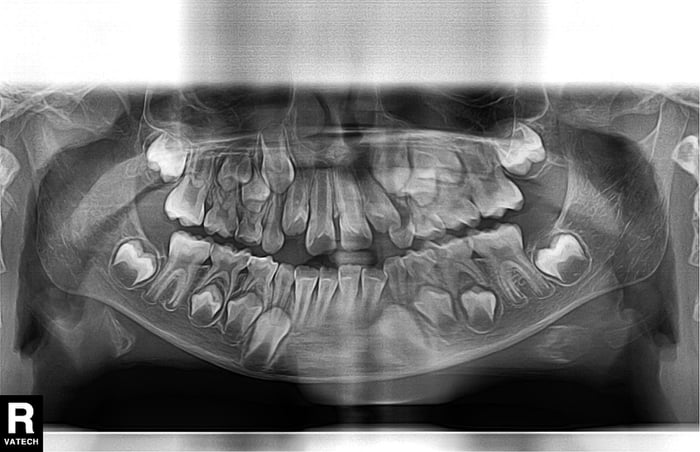 A kids x ray( normal teeth) but looks like an alien - 9GAG