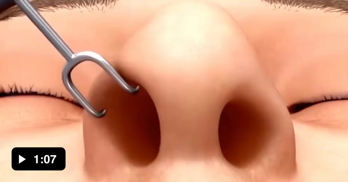 How a nose jobs works (animation) - 9GAG