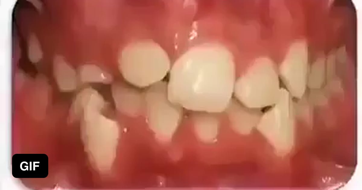 Watch braces in action, repairing unrepairable gnarly teeth. - 9GAG