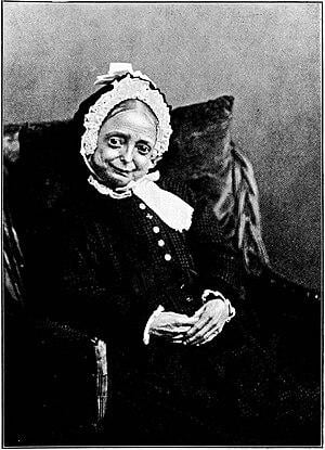 Premature old age apparently secondary to proportional dwarfism ...