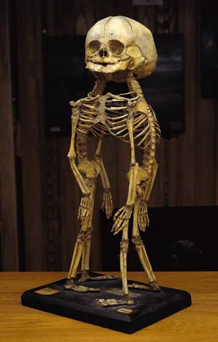 Amazing Conjoined twins skeleton - 9GAG