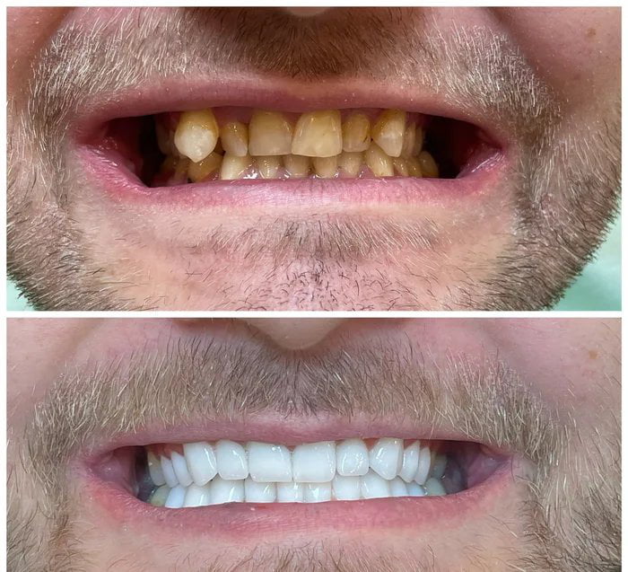 Needed to share this with others. Finally decided to fix my teeth after ...