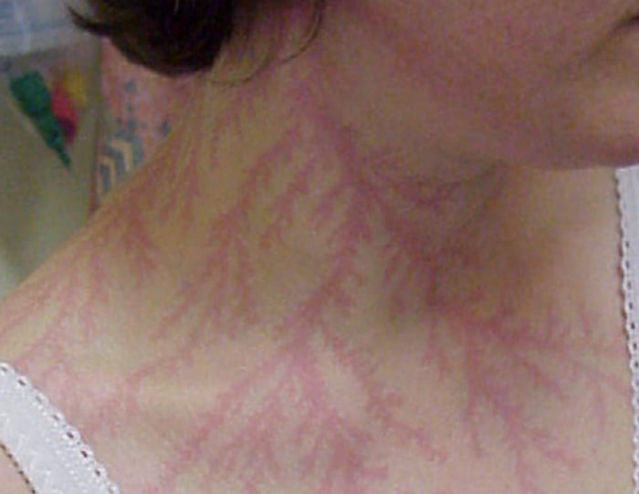 Skin findings on a woman who was electrocuted through her landline ...