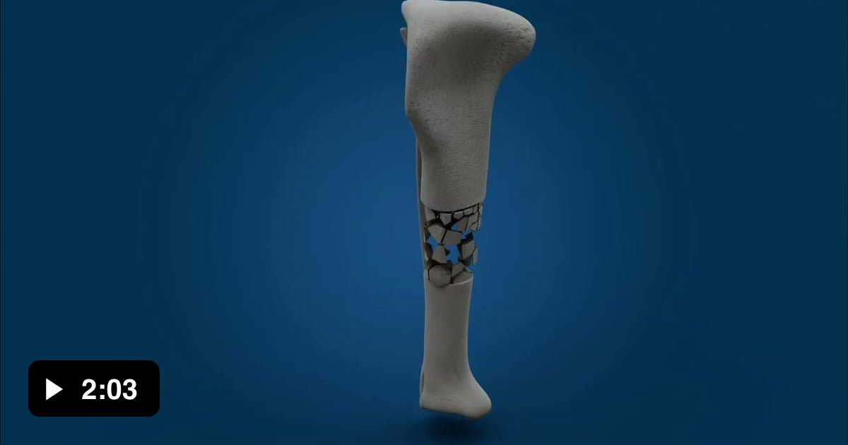 Ilizarov Technique, a method to lengthen a bone by "fracturing" and ...