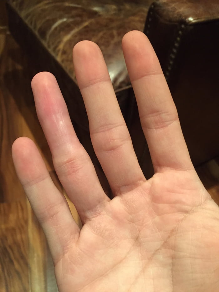 Had to wear a split on my broken finger for so long that the bend line ...