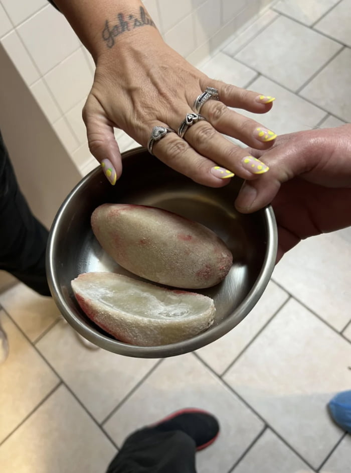 Of a bladder stone - 9GAG