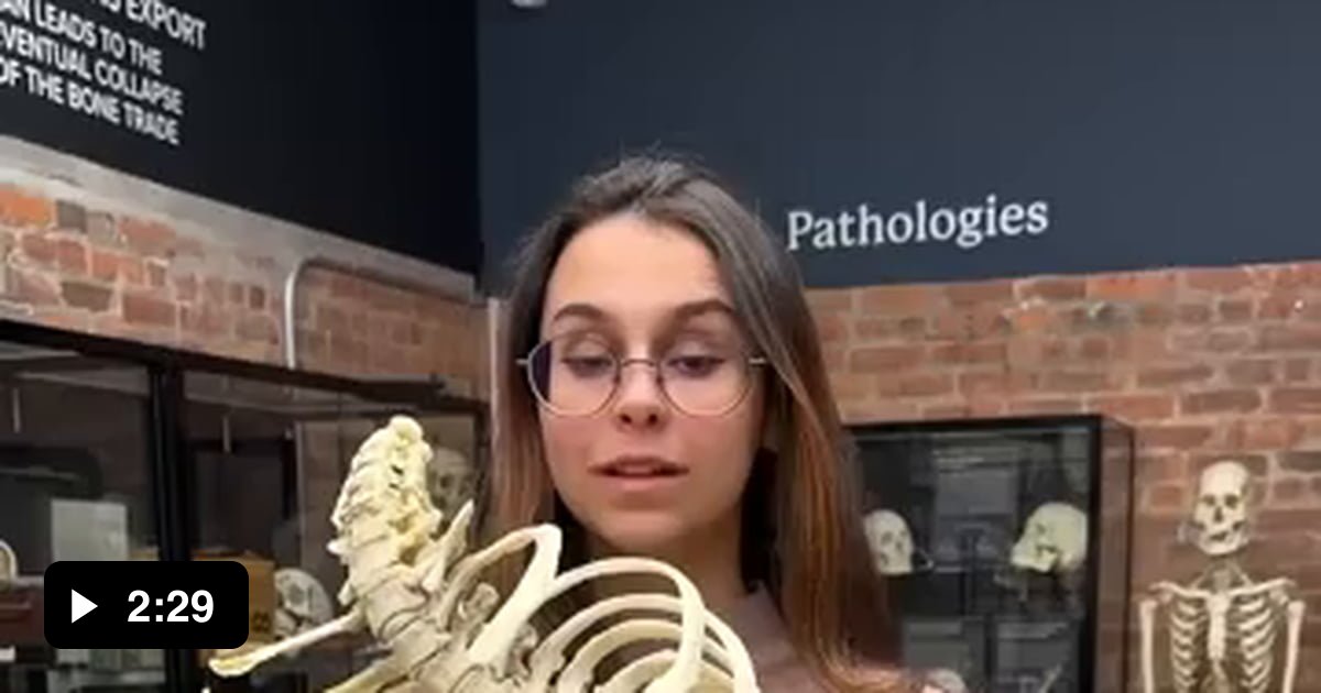 (The Bone Museum) Exploring scoliosis - 9GAG