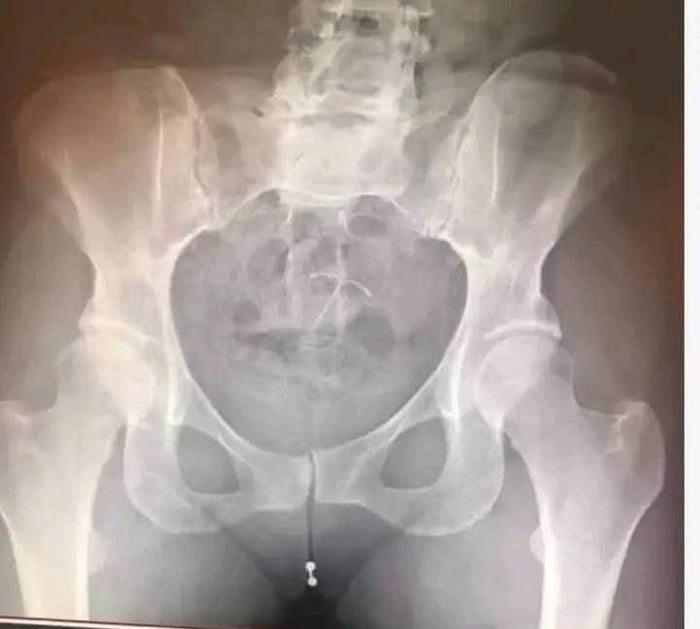 Strange little thing on the X-ray - 9GAG