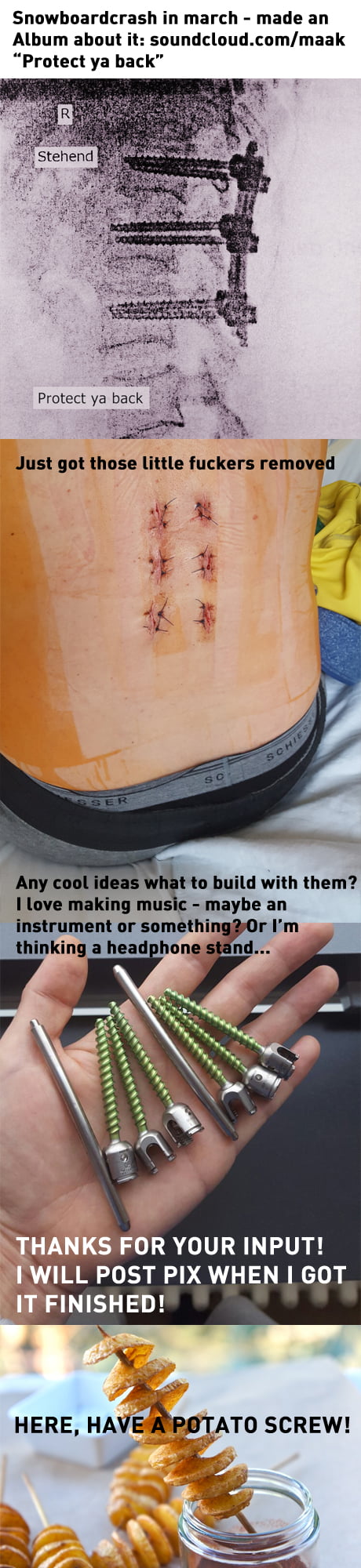 Just got those screws removed from my back - what should I build with it? - 9GAG
