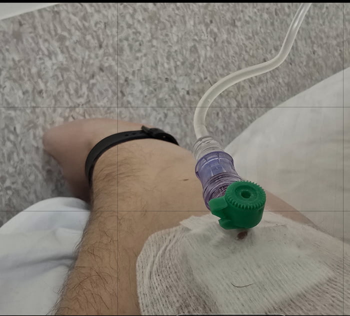 Hi guys. I had testicle removal surgery yesterday. Everything is fine ...