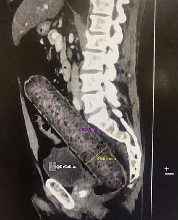 CT Scan shows a 10 inch sausage within rectum - 9GAG