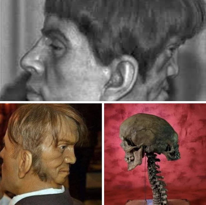 The skull of Edward Mordrake, the man born with a second face in the ...
