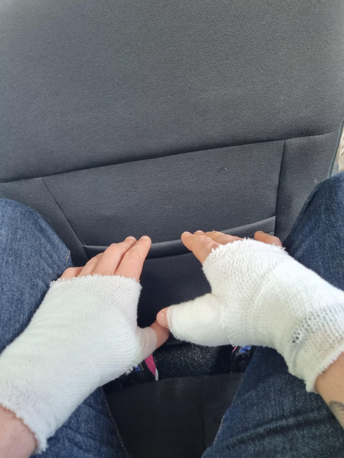 Burned both hands - 9GAG