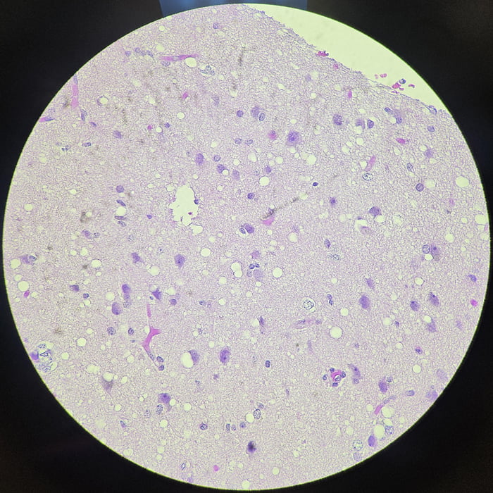 Brain tissue of a CJD patient under a microscope, showing holes ...