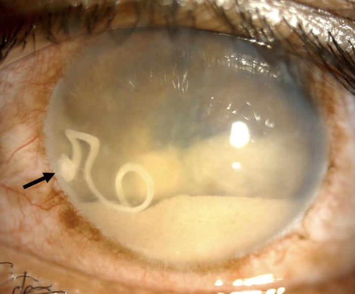 Eye with a live tapeworm inside - 9GAG