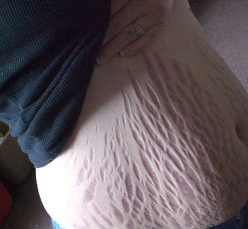 Insane stretch marks - 9GAG