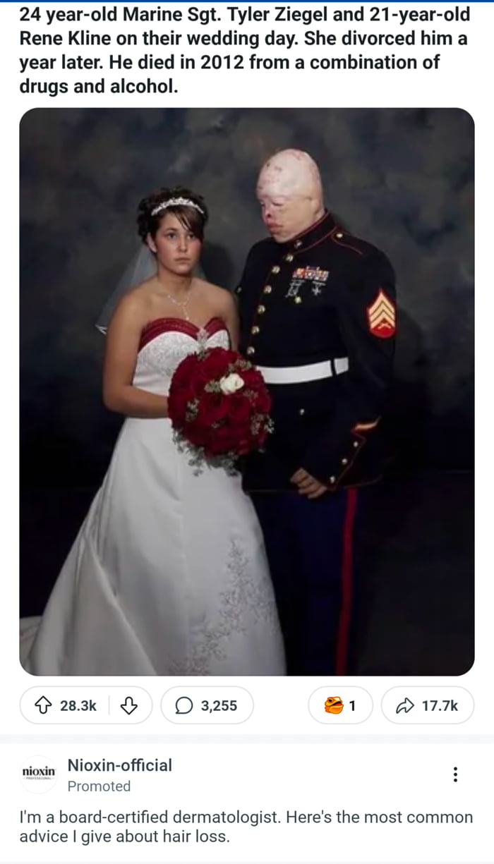 Hairloss Ad Placement - 9GAG