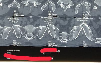 With all the hype of mri pug, I give sacrum bone on a CT scan. Look at ...