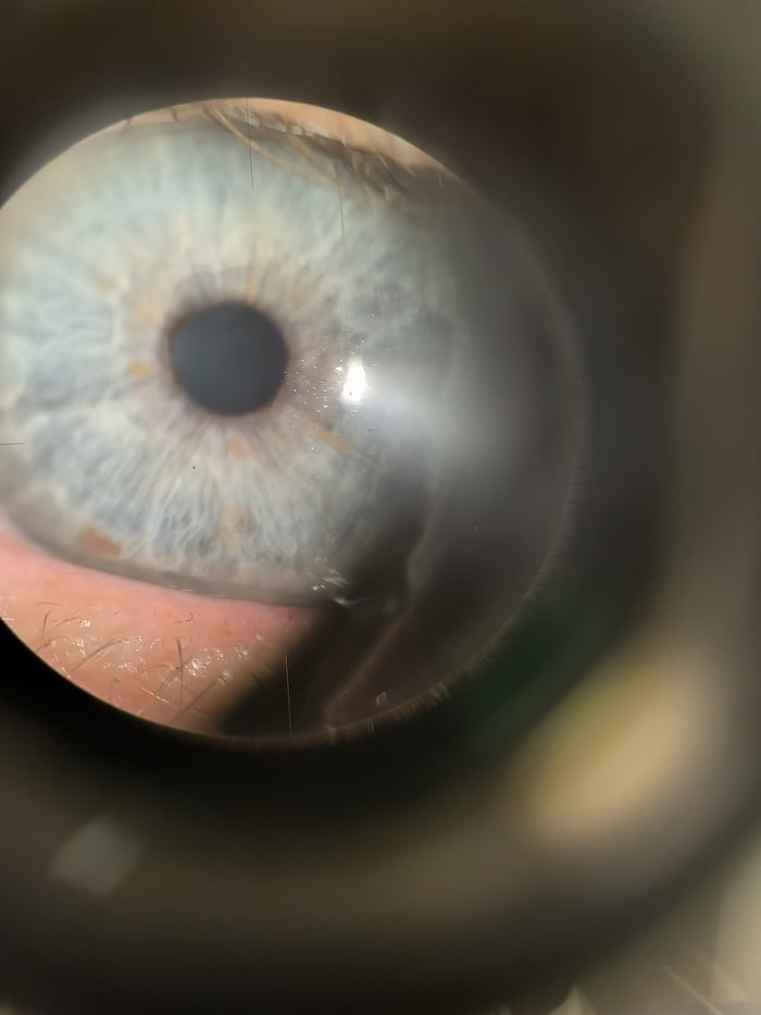 Random stuff from an optometry clinic: Debris in the tear film due to ...